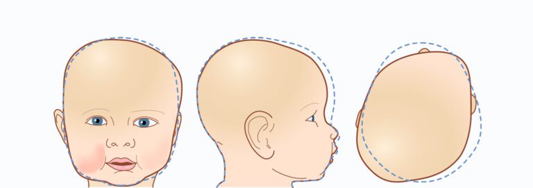 Cranial Helmets for Infant Head Shaping (Cranial Remolding Orthoses)