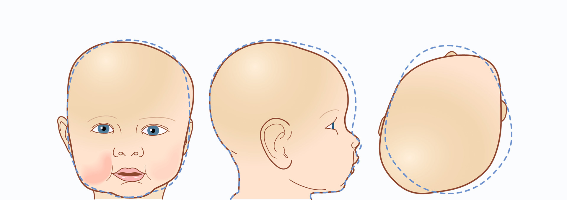 Cranial Helmets for Infant Head Shaping (Cranial Remolding Orthoses)